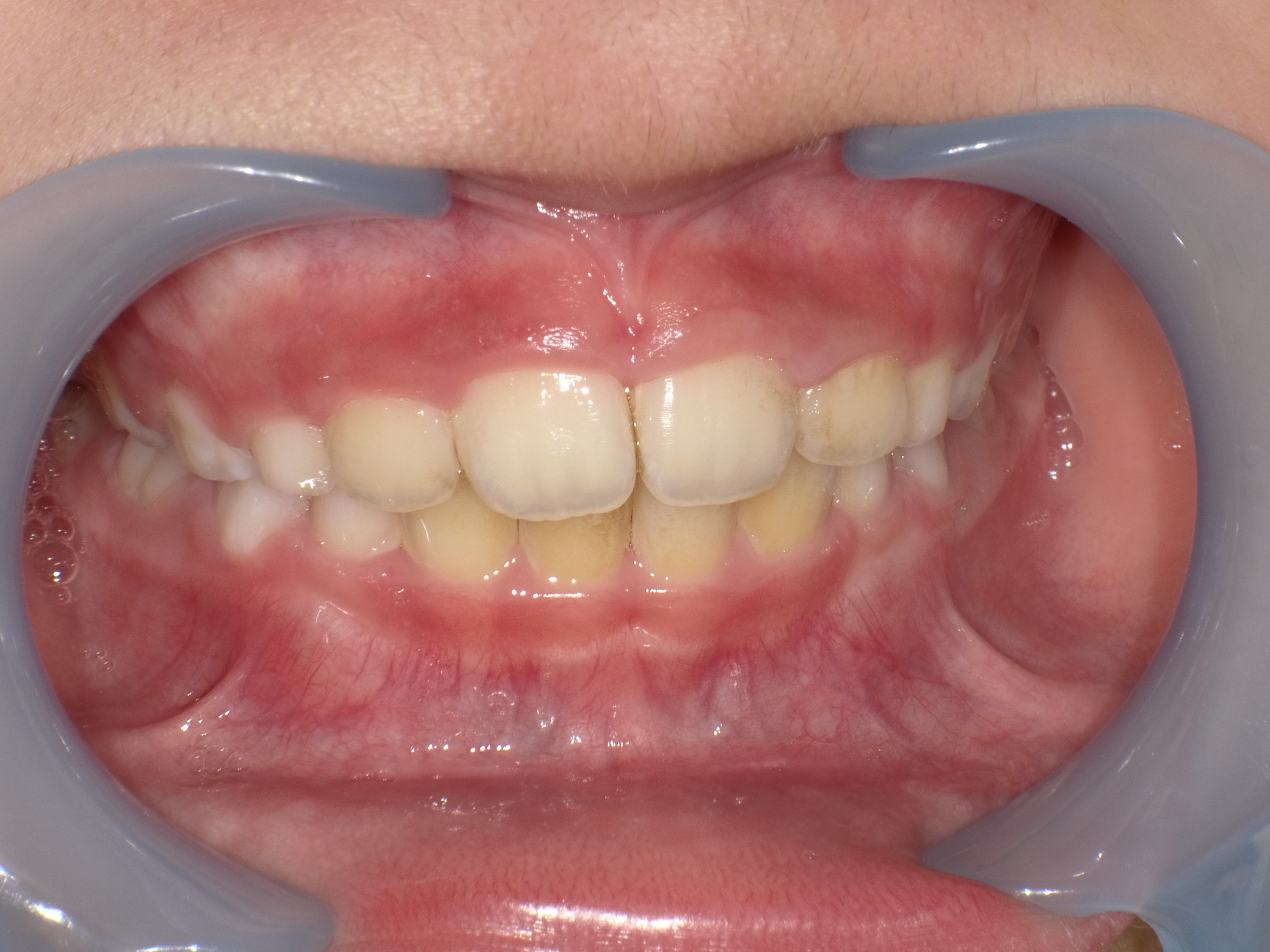 SHOFU DENTAL DIGITAL CAMERA | ひろし歯科